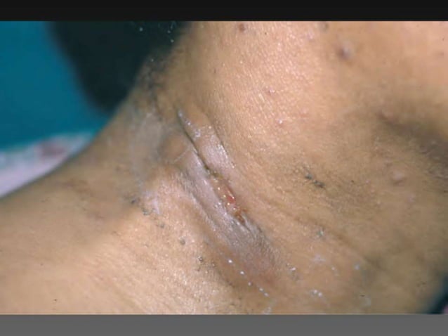 Cutaneous Tuberculosis | PPT