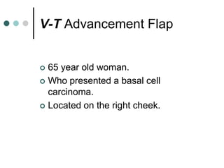 V-T advancement flap. | PPT | Skin and Dermatology | Diseases and ...