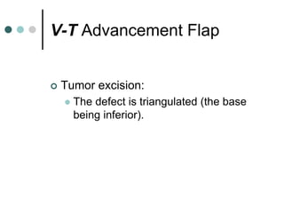 V-T advancement flap. | PPT