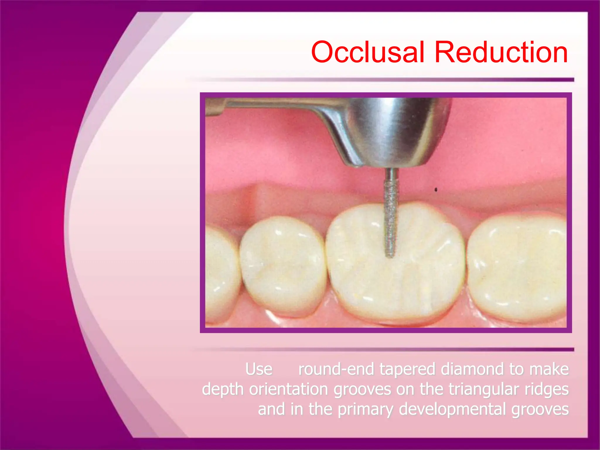 full veneer tooth preparation principals and steps | PPTX