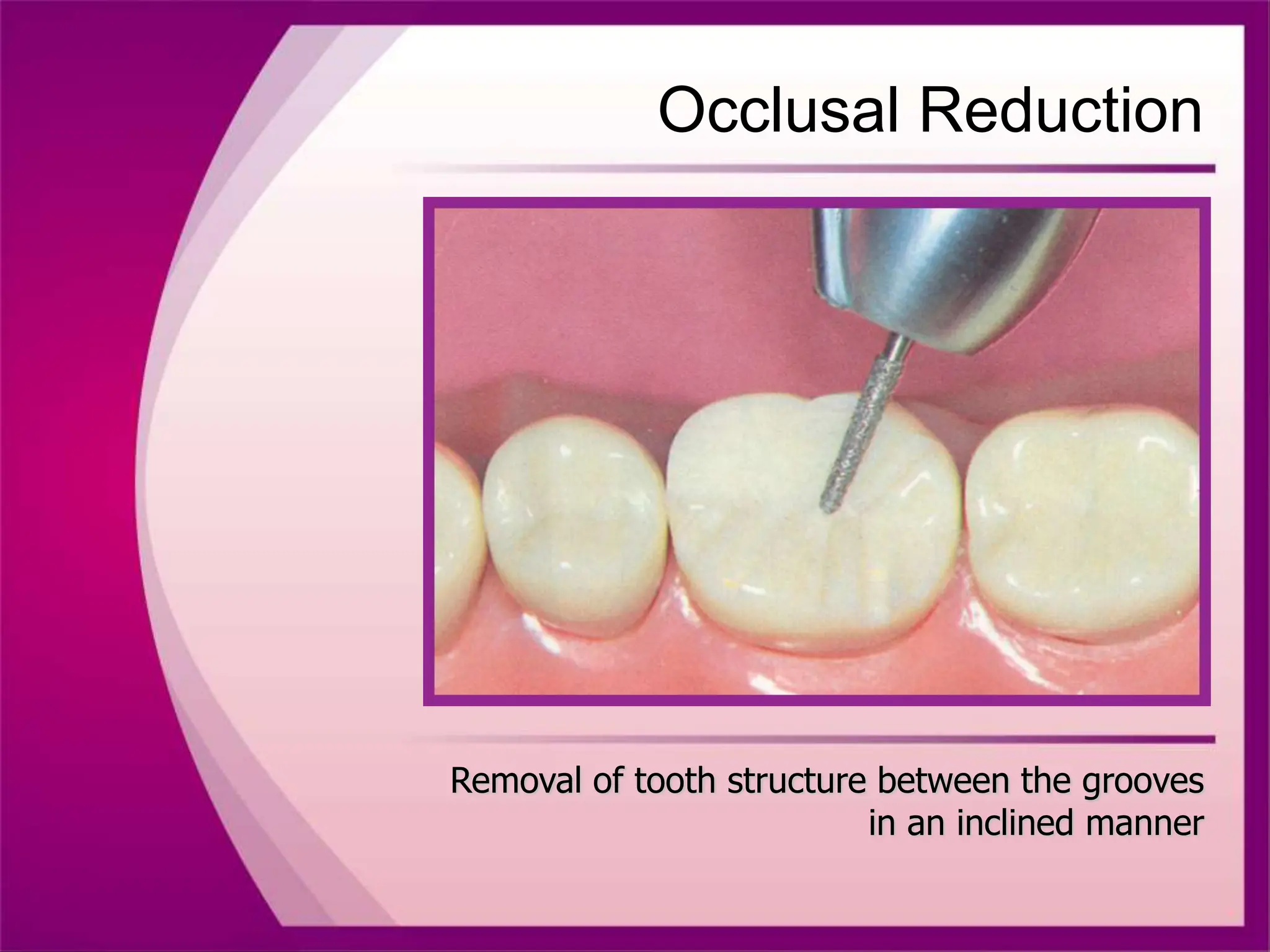full veneer tooth preparation principals and steps | PPTX