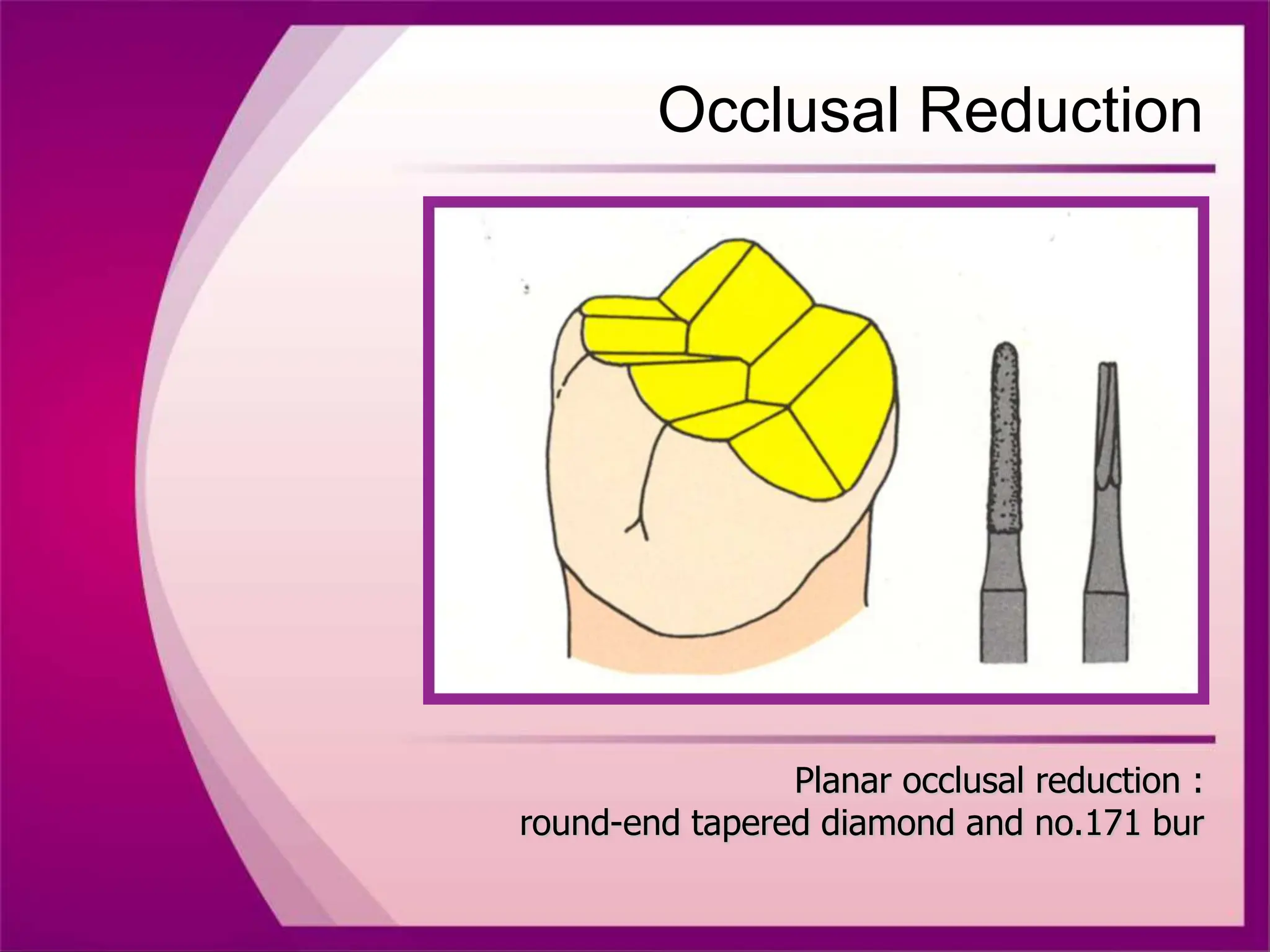 full veneer tooth preparation principals and steps | PPTX