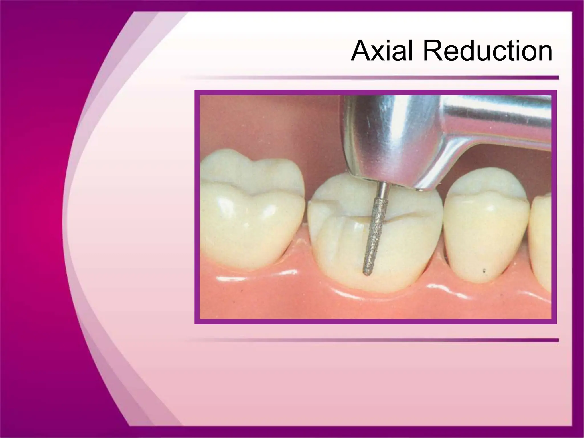 full veneer tooth preparation principals and steps | PPTX