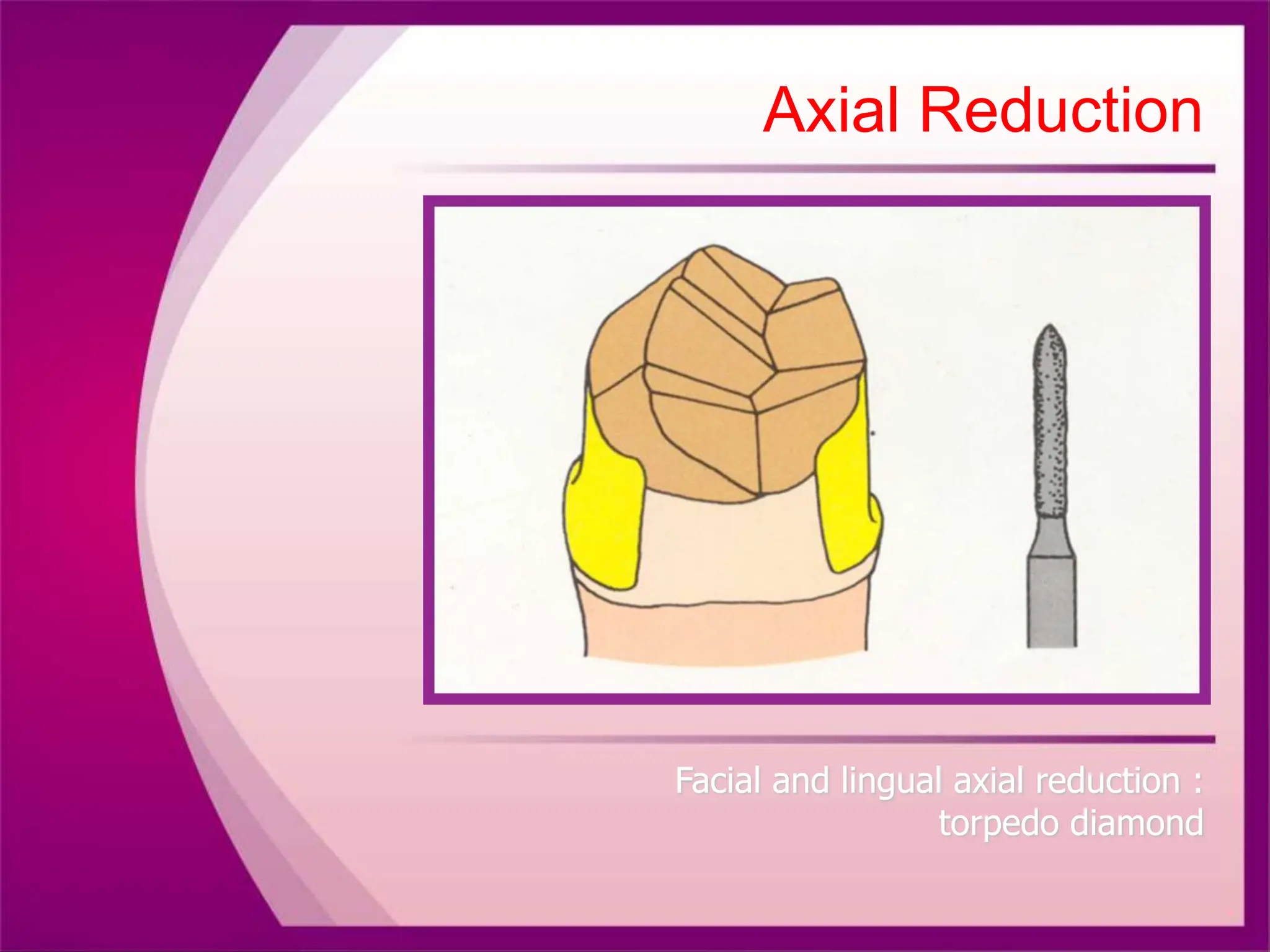 full veneer tooth preparation principals and steps | PPTX