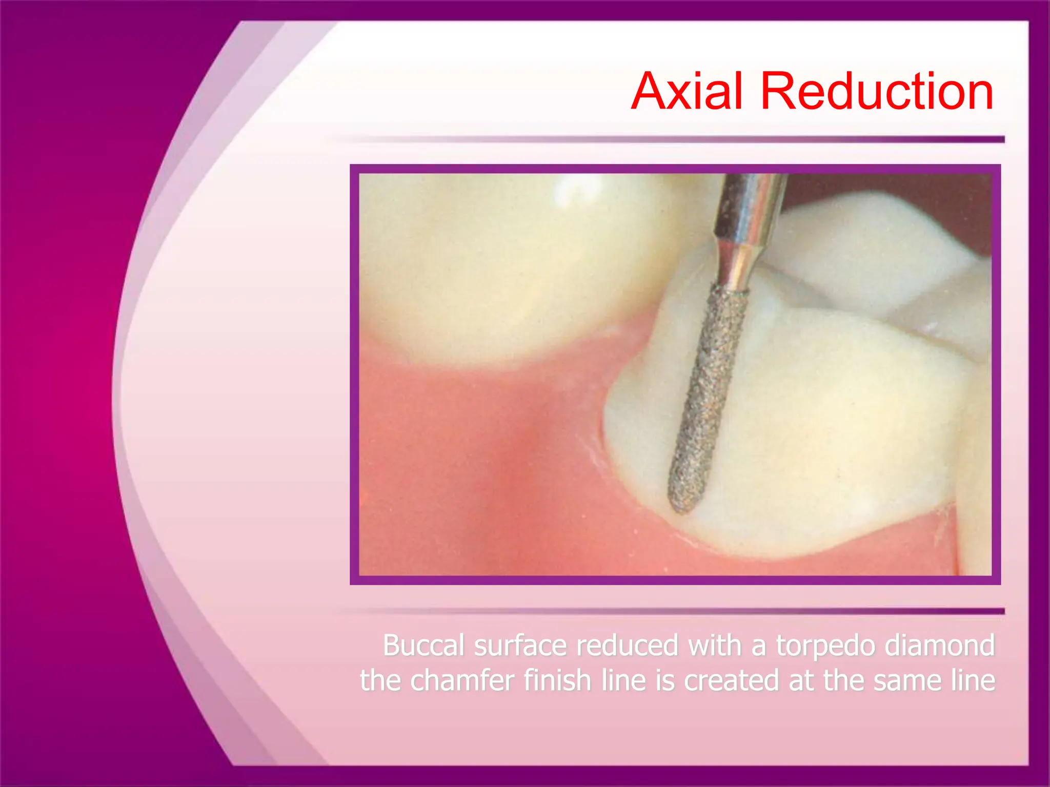 full veneer tooth preparation principals and steps | PPTX