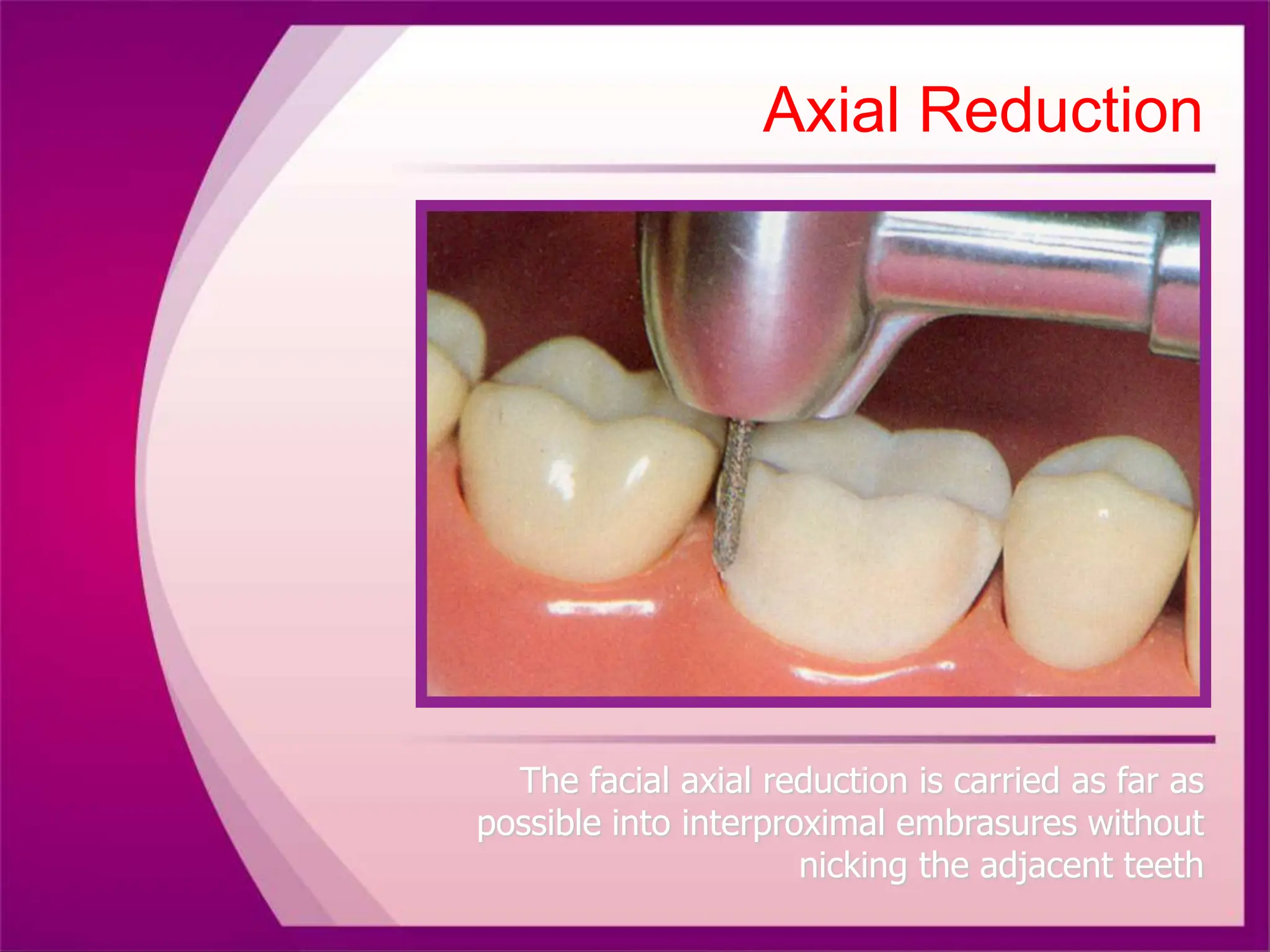 full veneer tooth preparation principals and steps | PPTX