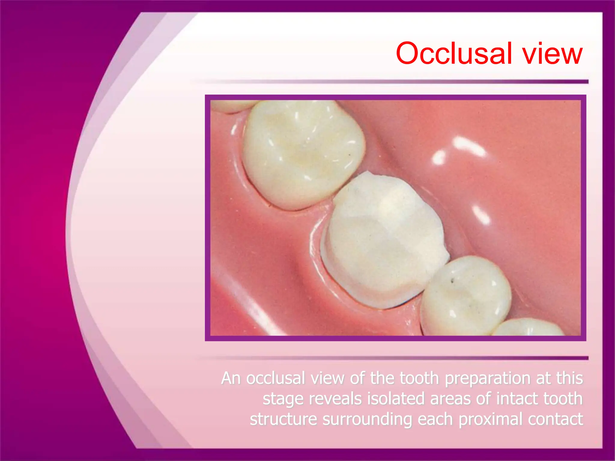 full veneer tooth preparation principals and steps | PPTX