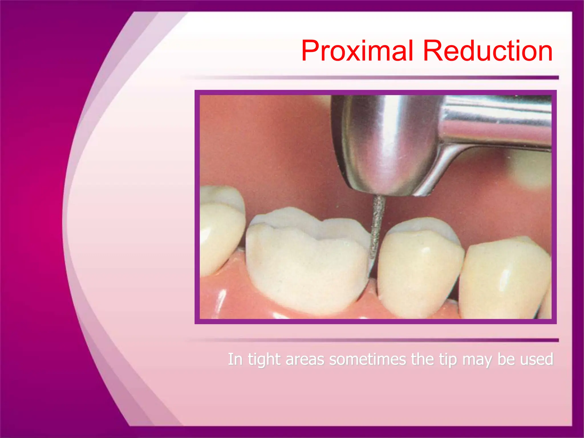 full veneer tooth preparation principals and steps | PPTX