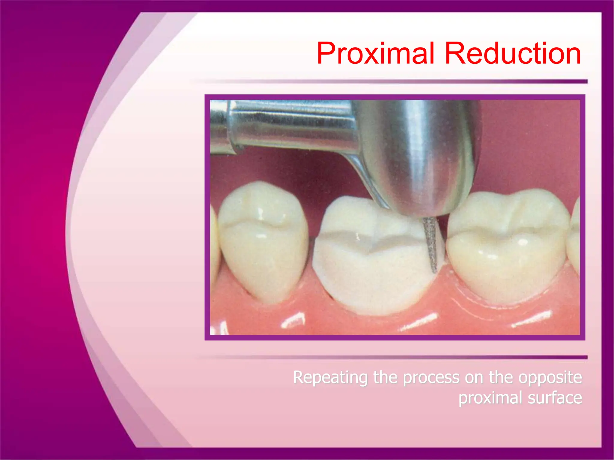 full veneer tooth preparation principals and steps | PPTX