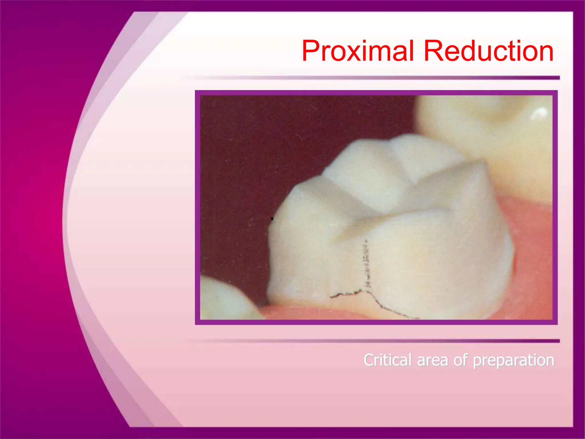full veneer tooth preparation principals and steps | PPTX