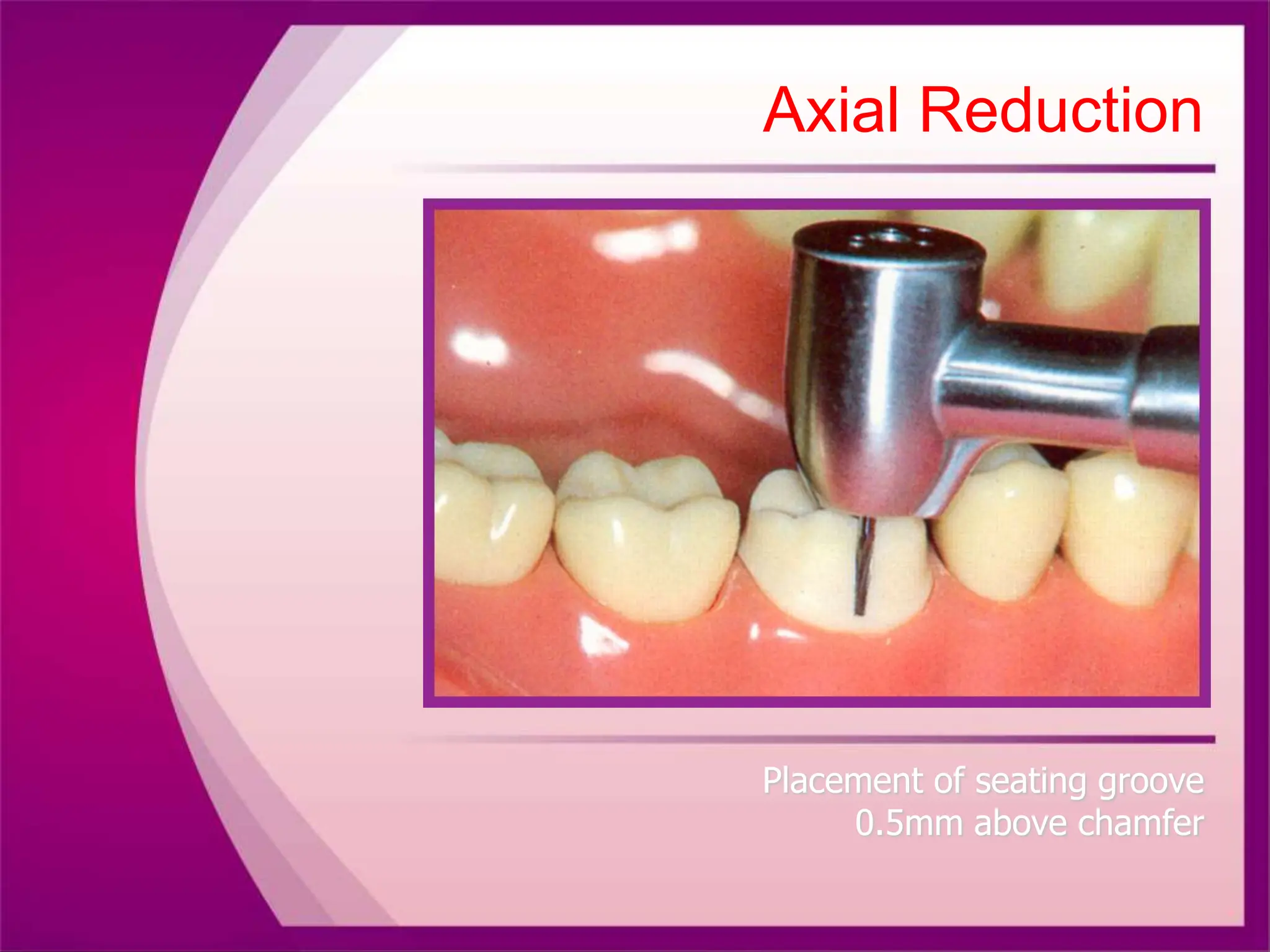 full veneer tooth preparation principals and steps | PPTX