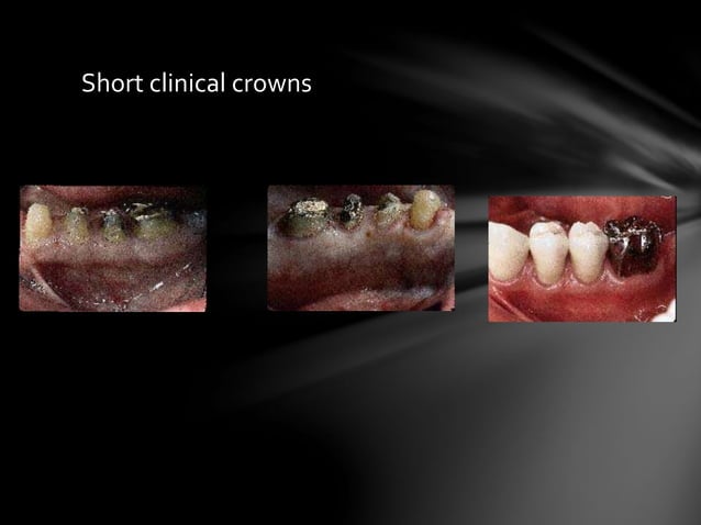 full veneer tooth preparation principals and steps | PPTX