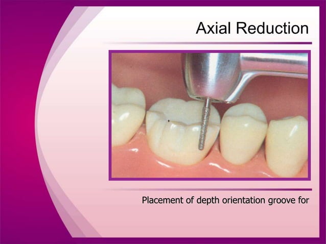 full veneer tooth preparation principals and steps | PPTX