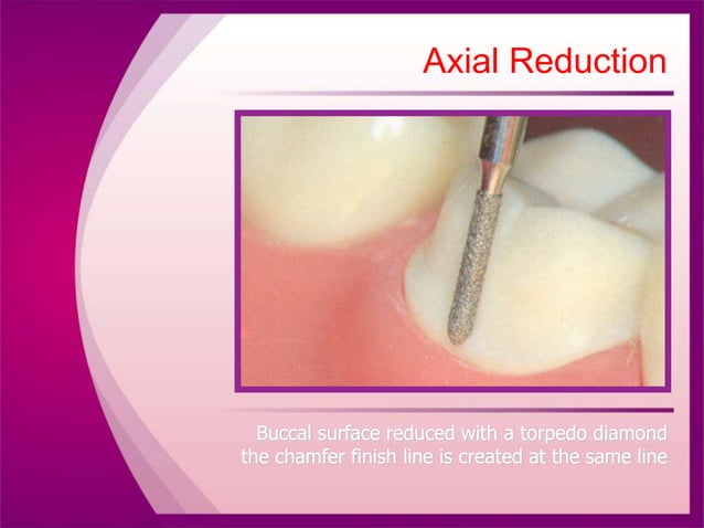 full veneer tooth preparation principals and steps | PPTX