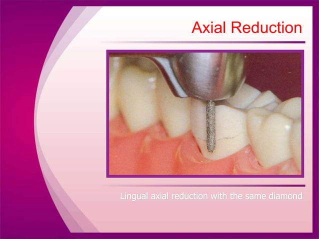 full veneer tooth preparation principals and steps | PPTX