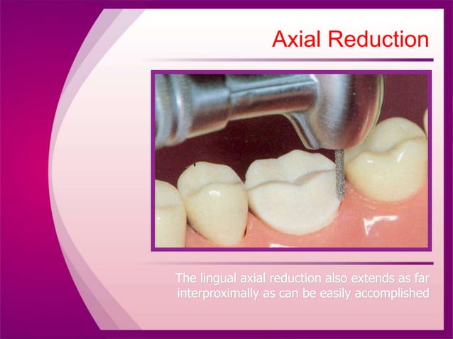 full veneer tooth preparation principals and steps | PPTX