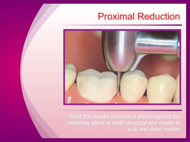 full veneer tooth preparation principals and steps | PPTX