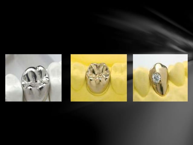 full veneer tooth preparation principals and steps | PPTX