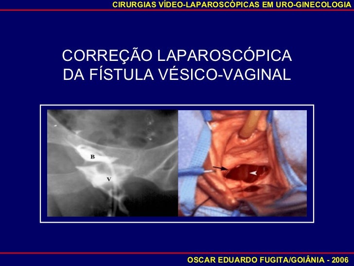 Correção Laparoscópica da Fístula Vésico-vaginal