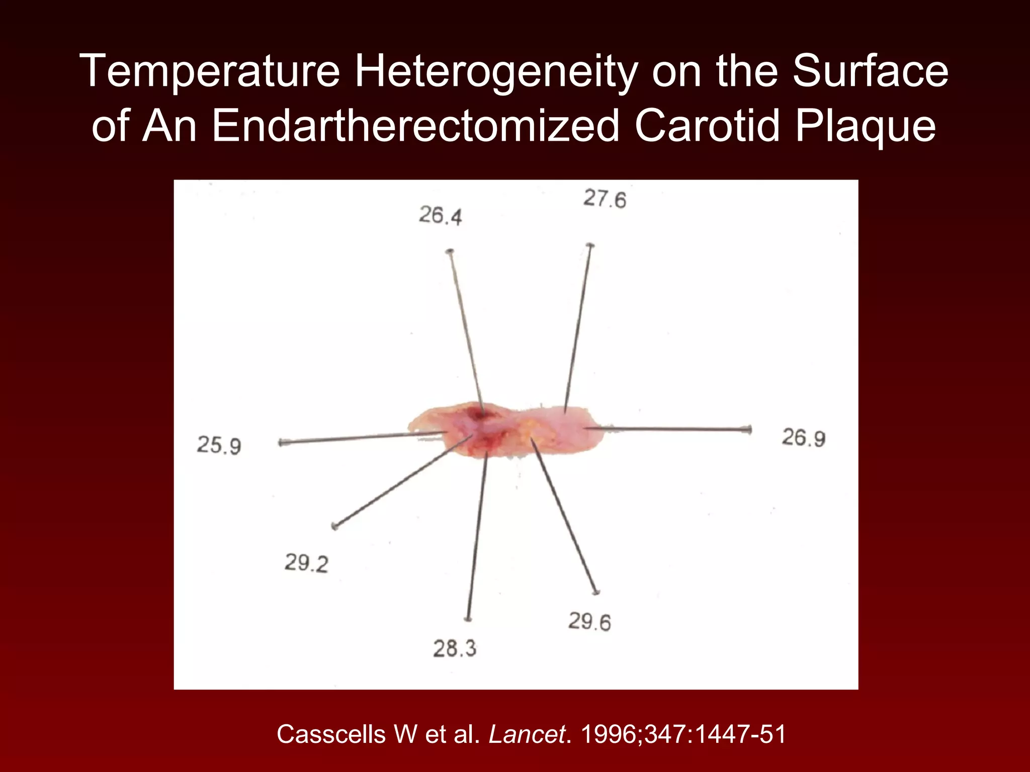 095 thermography idenitfying vulnerable plaques | PPT