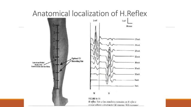 Presentation about late responses f wave h reflex.ppt | Death, Injury ...