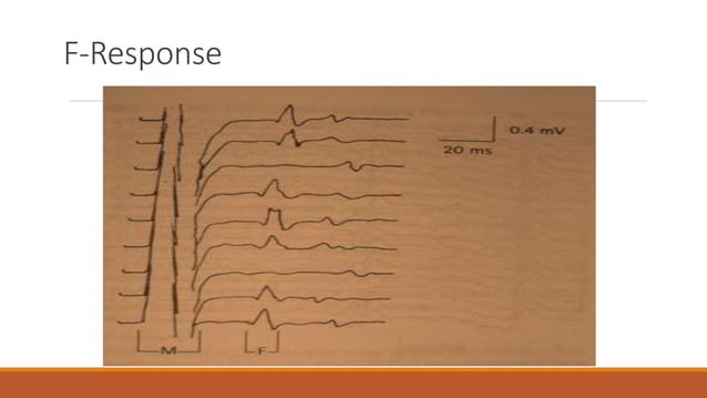 Presentation about late responses f wave h reflex.ppt | Death, Injury ...