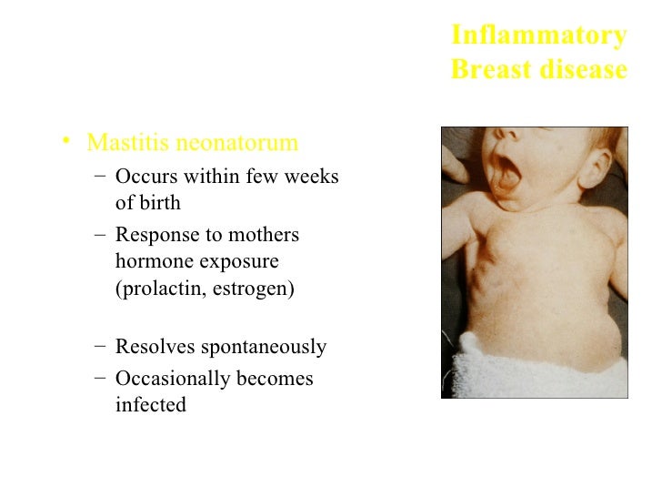 Fwd: Benign Breast Disease Mr. Evoy