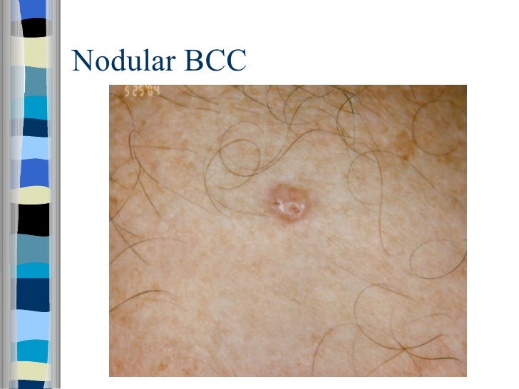 Fwd: Skin Cancer (Cormac Joyce)