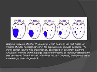 Pca3 urinario | PPT