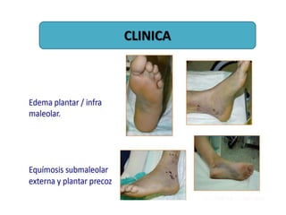 Fx. de calcaneo poin | PPTX