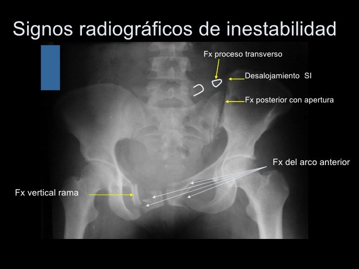 Fx De Pelvis