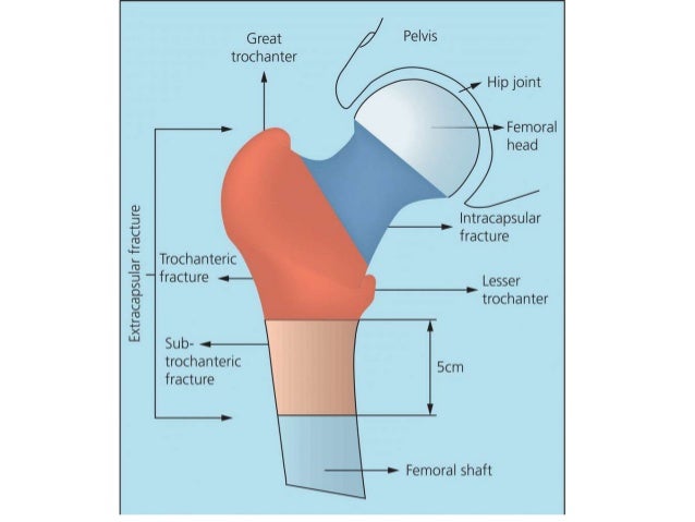 Intertrochanteric-fx