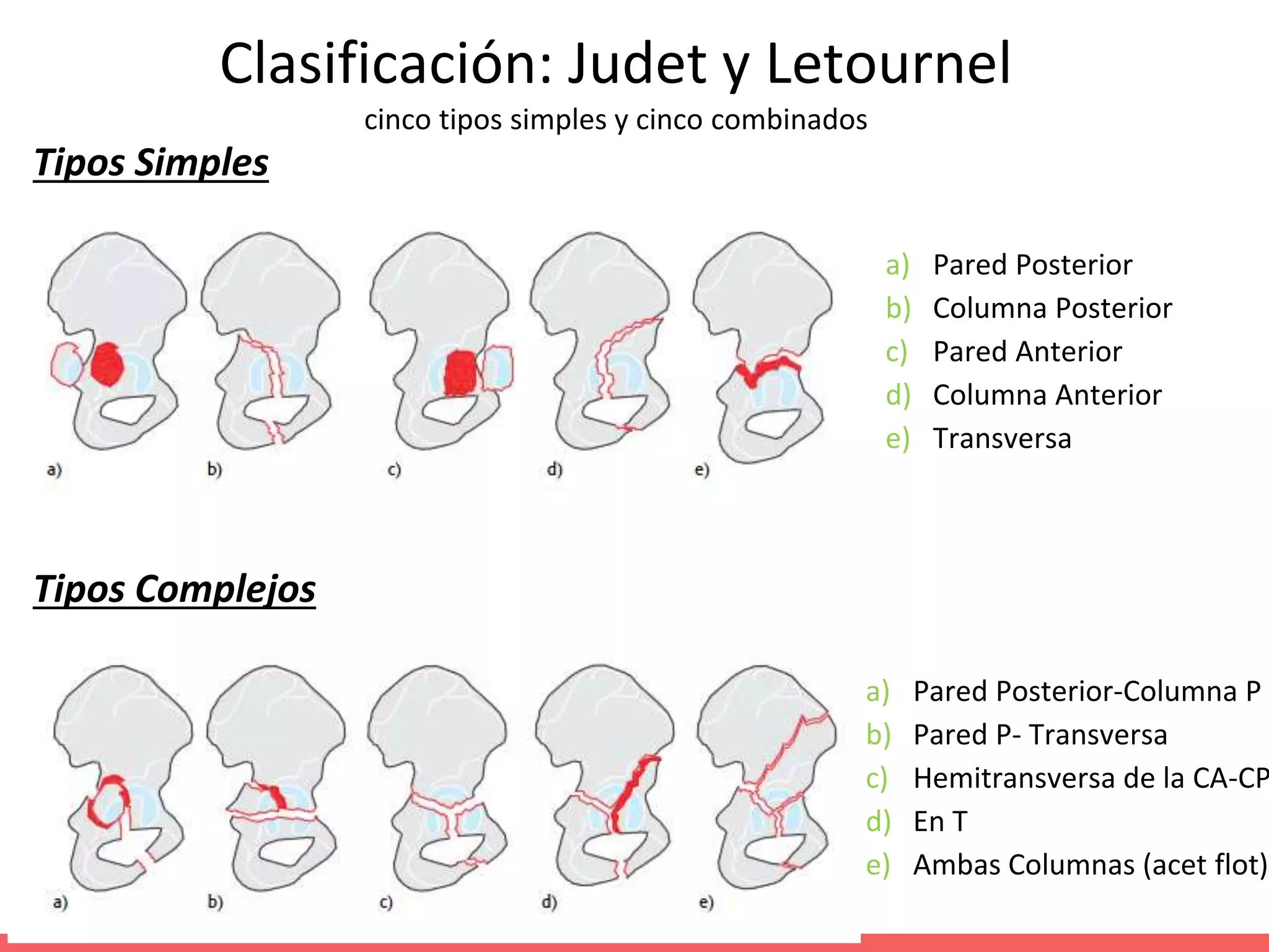 Fracturas de acetabulo.ppt