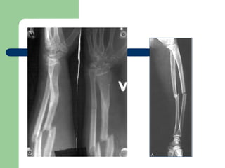 Fracturas del antebrazo proximaal distal | PPT