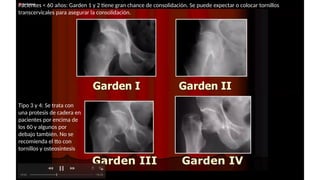 Fx de cadera - ortopedia y traumatologia | PPTX