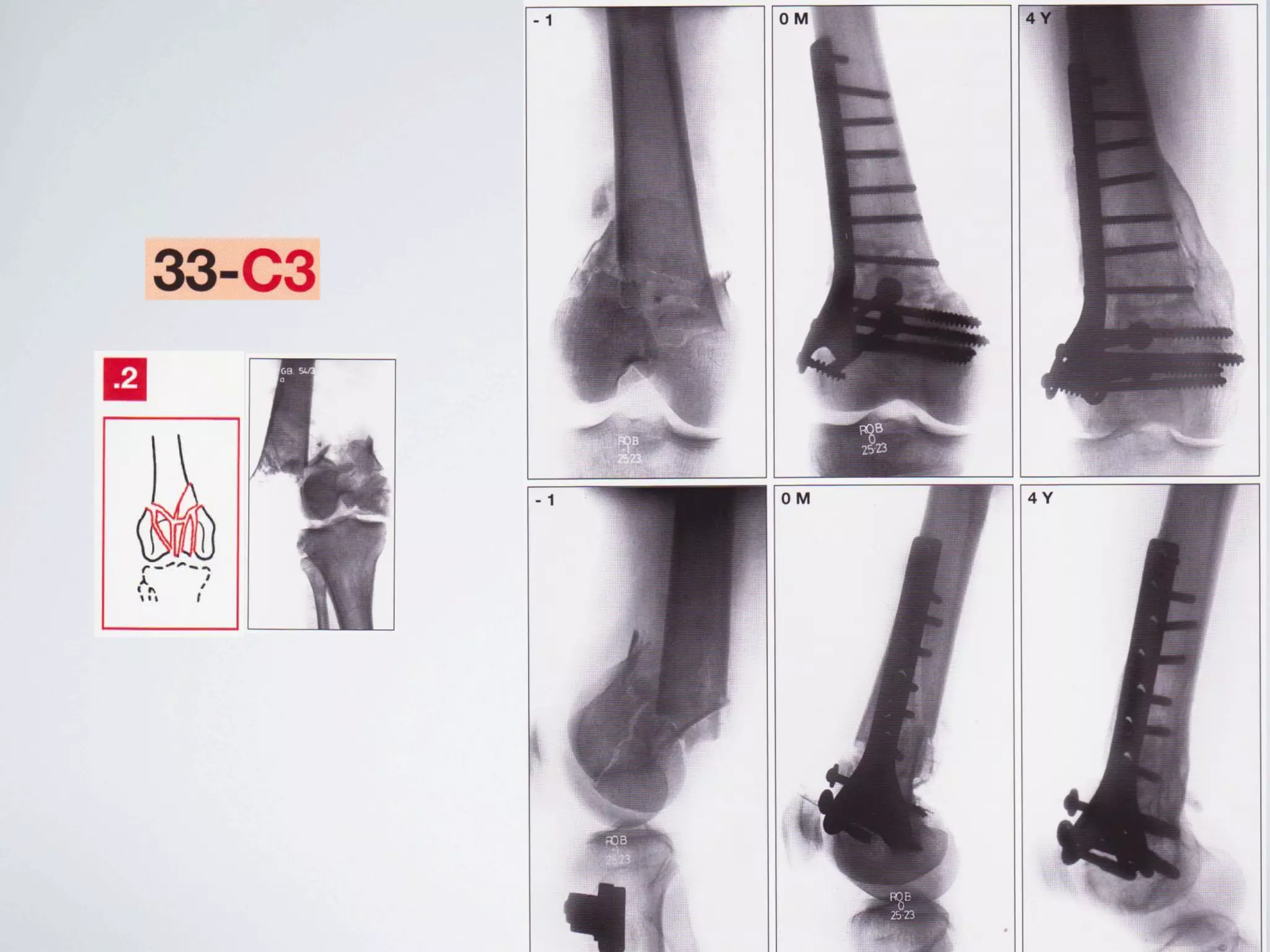 Fracturas de Femur Distal | KEY