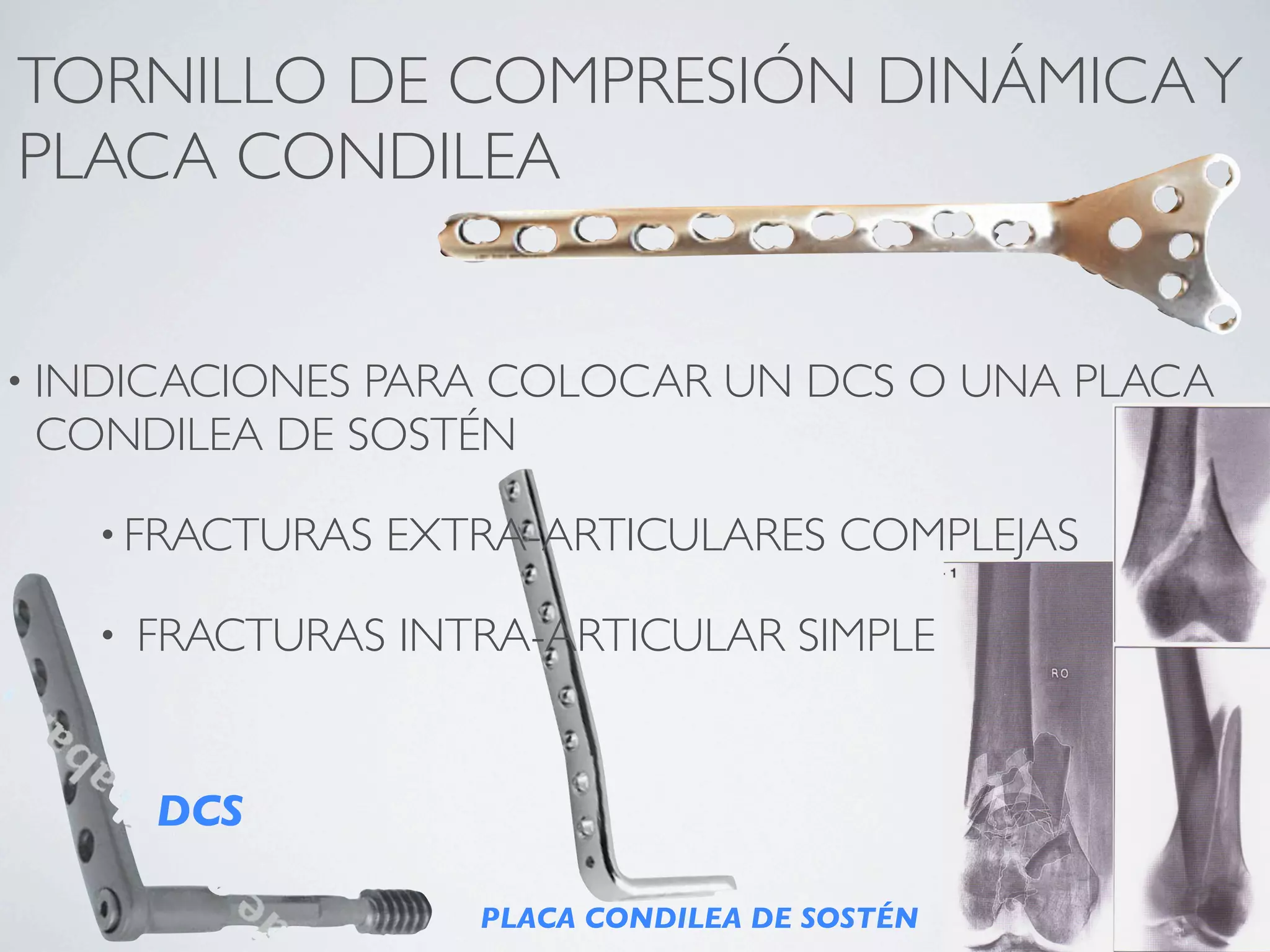 Fracturas de Femur Distal | KEY