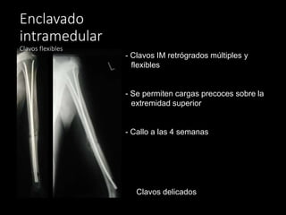 fractura de diafisis de humero | PPTX