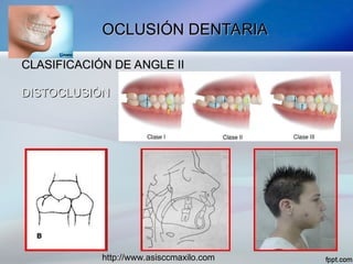 FX DE MANDIBULA anatomía, manejo y técnicas quirurvicas.ppt