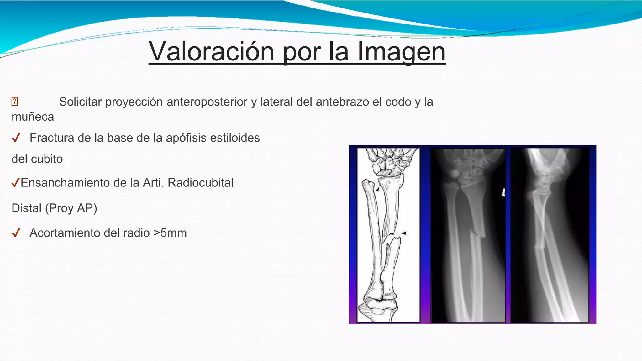 Fx de radio proximal, medio y distal.pptx