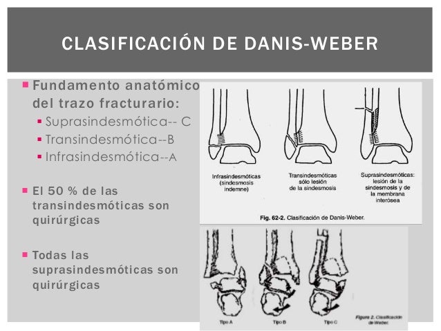 Fx de tibia y tobillo