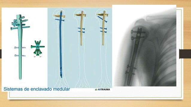 Fractura humero proximal | PPTX