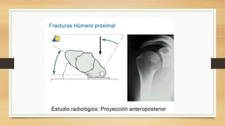 Fractura humero proximal