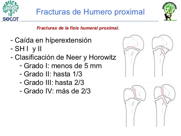 Fracturas de Cintura Escapular y humero en la infancia