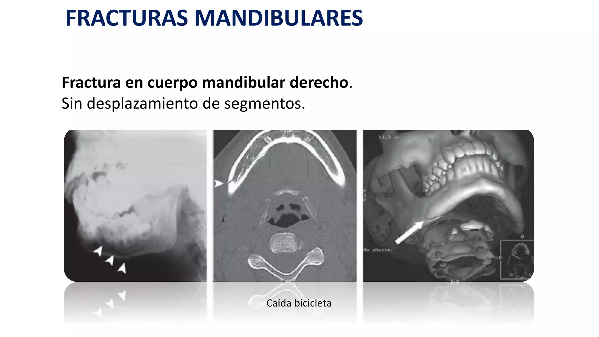 fracturas de mandibula en niños .pptx