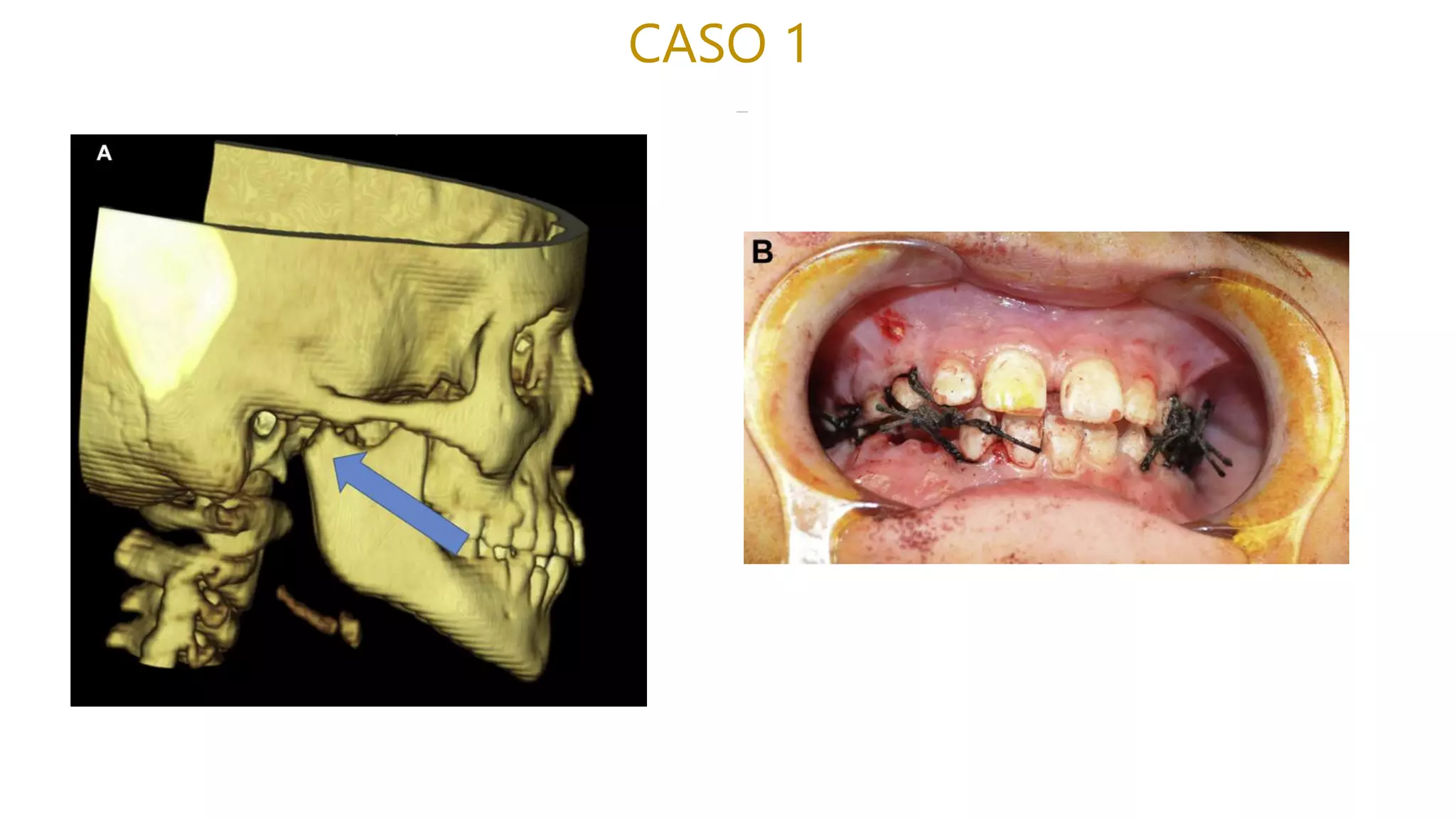 fracturas de mandibula en niños .pptx