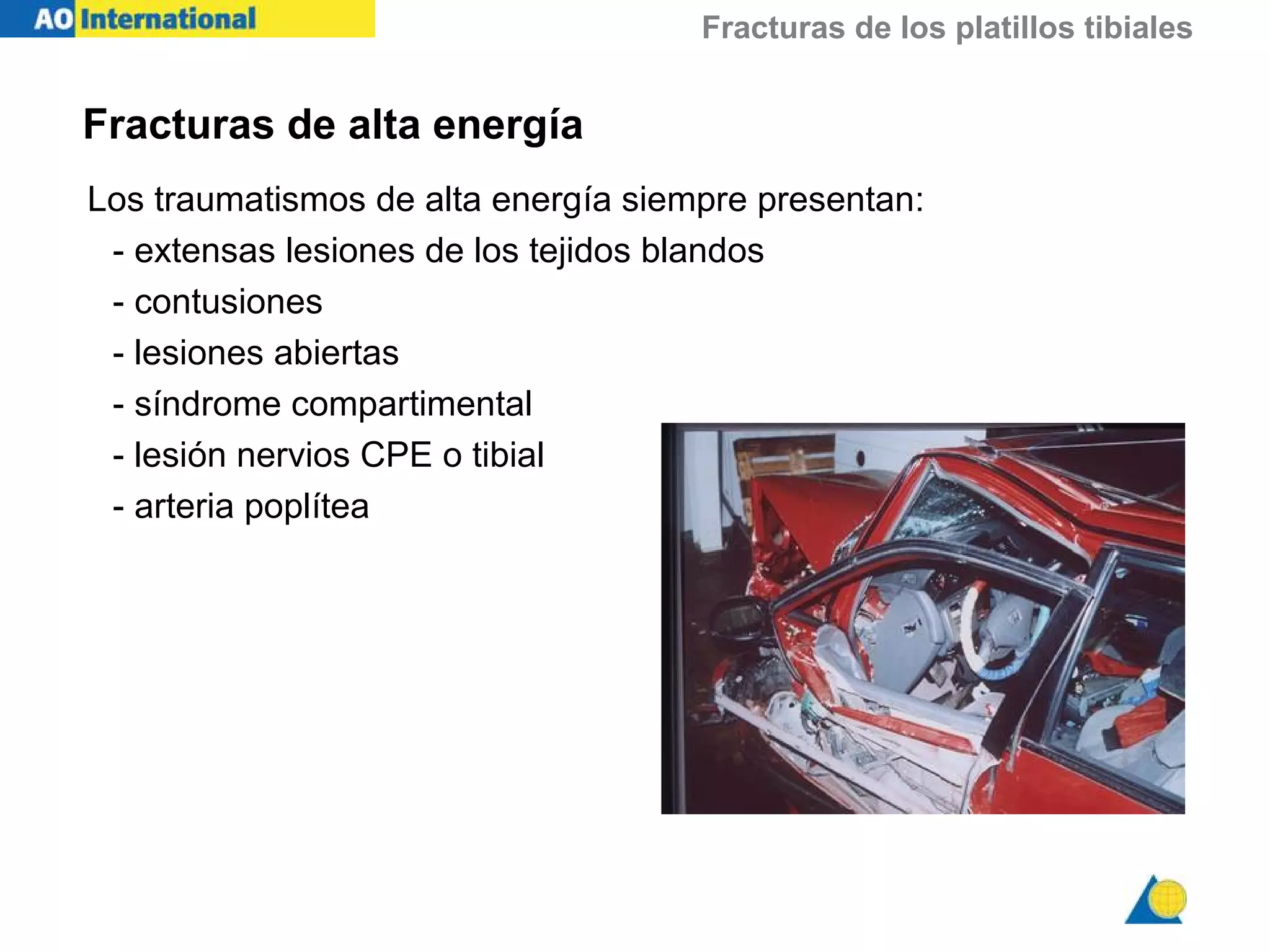 Fx platillo tibial | PPT