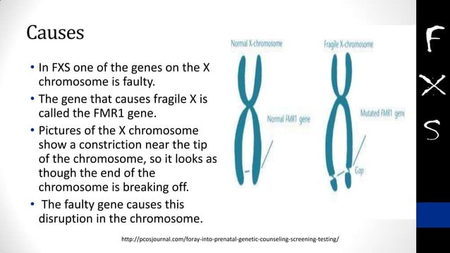 FRAGILE X SYNDROME ( FXS ) an inherited cause of mental retardation ...
