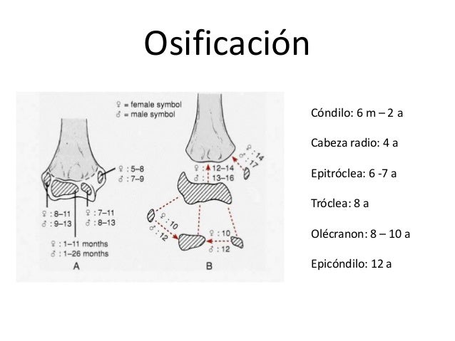 Fx supracondílea codo pediátrico