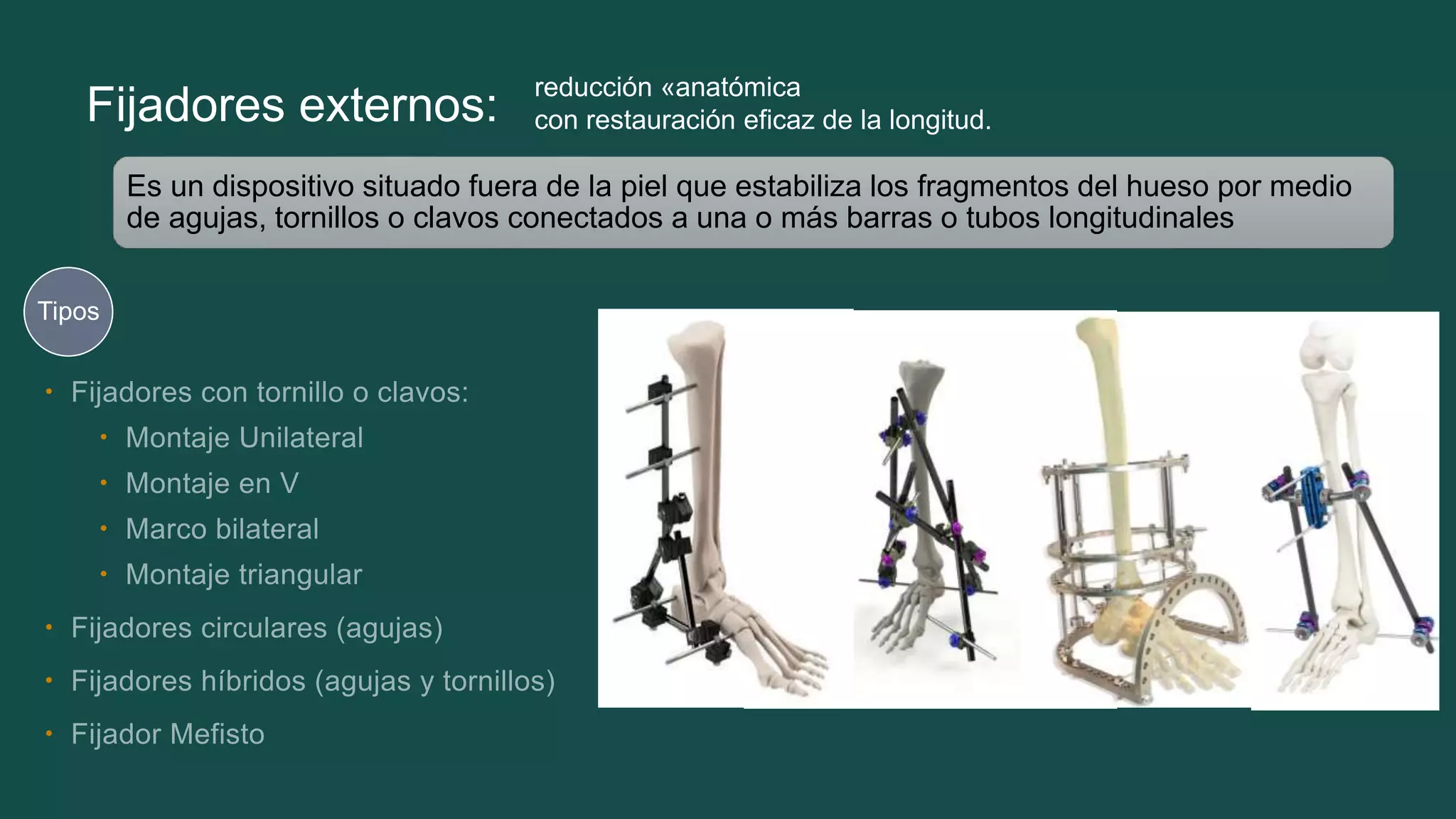 FX TIBIA METAFISIARIA DISTAL DE TIBIA.pptx